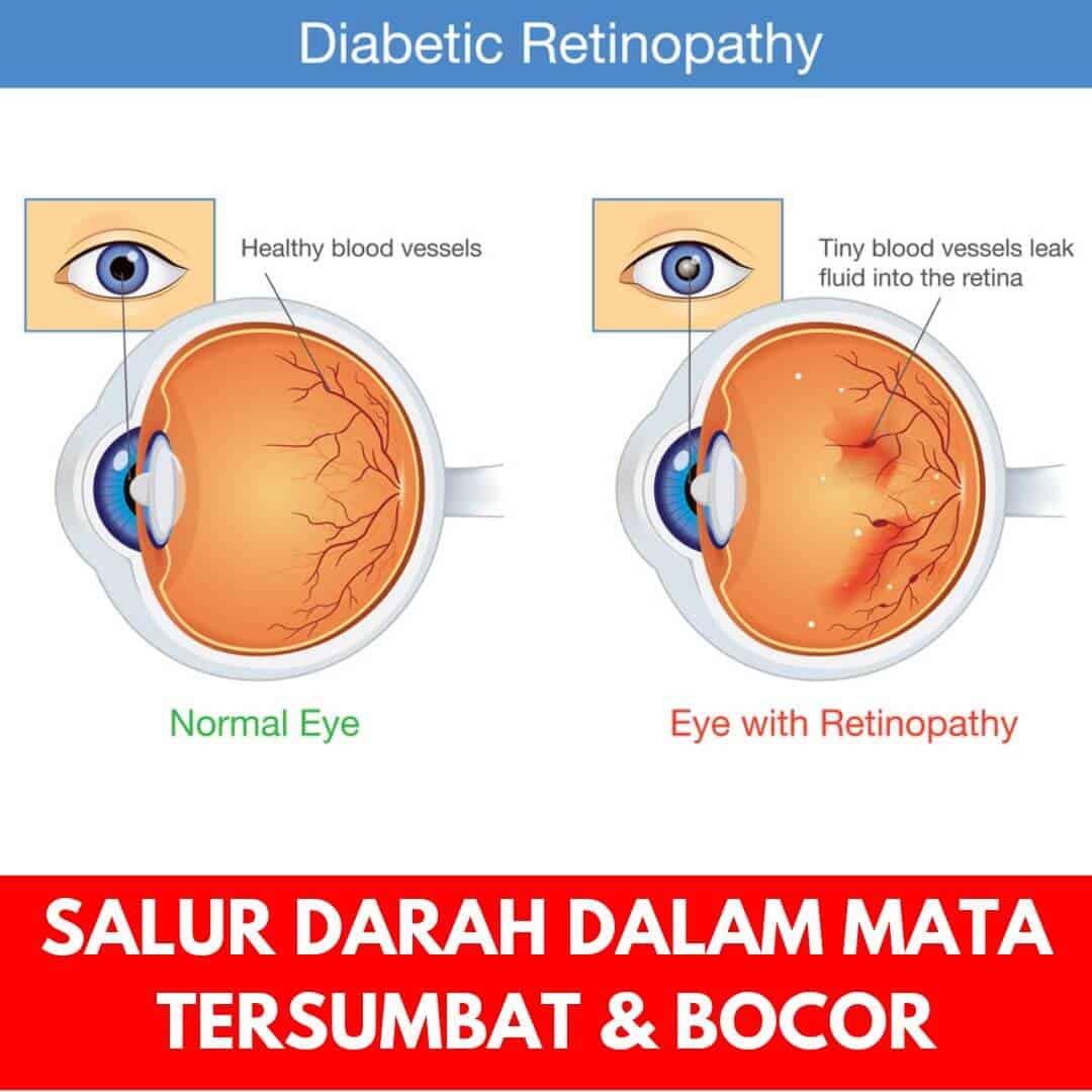 100% Tumbuhan Organik Khas Untuk Kawal Bacaan Gula & Rabun